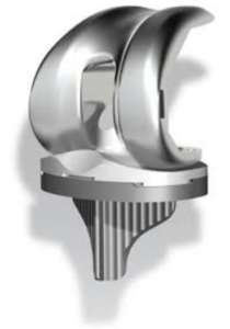 Knee Replacement (Total Knee Arthroplasty) | ISMI