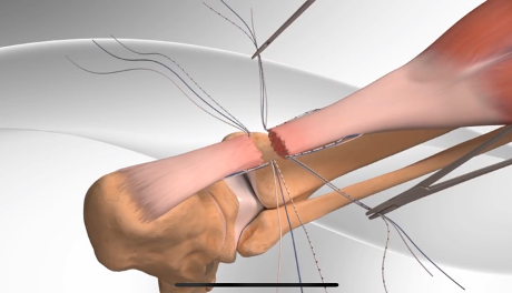 Achilles Tears, Torn Achilles, and Symptoms | ISMI