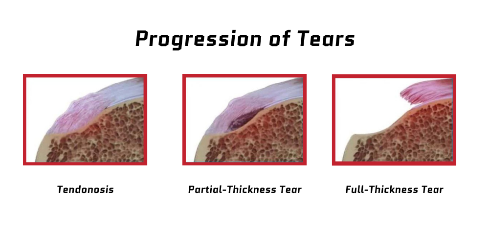 Partial Rotator Cuff Tears: Diagnosis and Treatment – ISMI – Boise ...